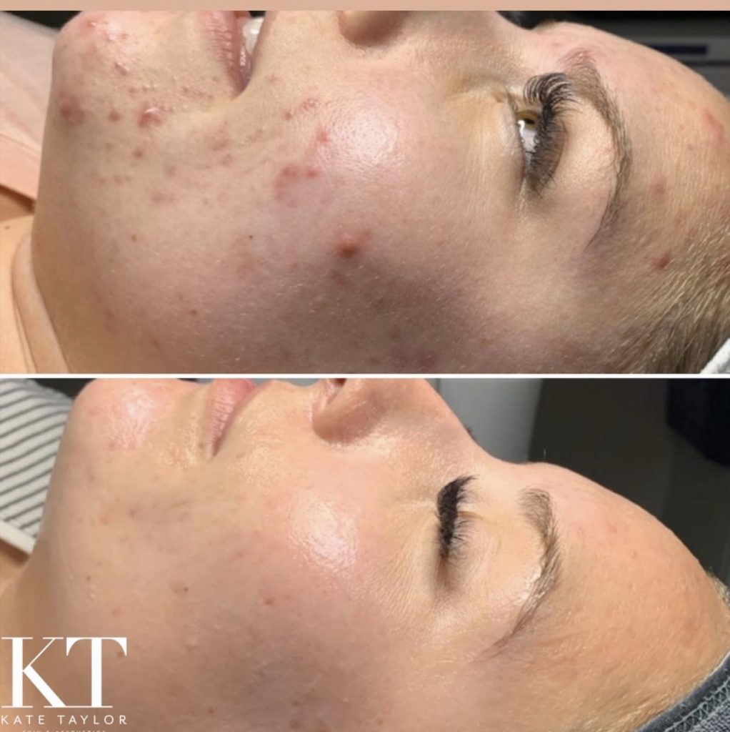 DermaQuest – KT skin and Aesthetics