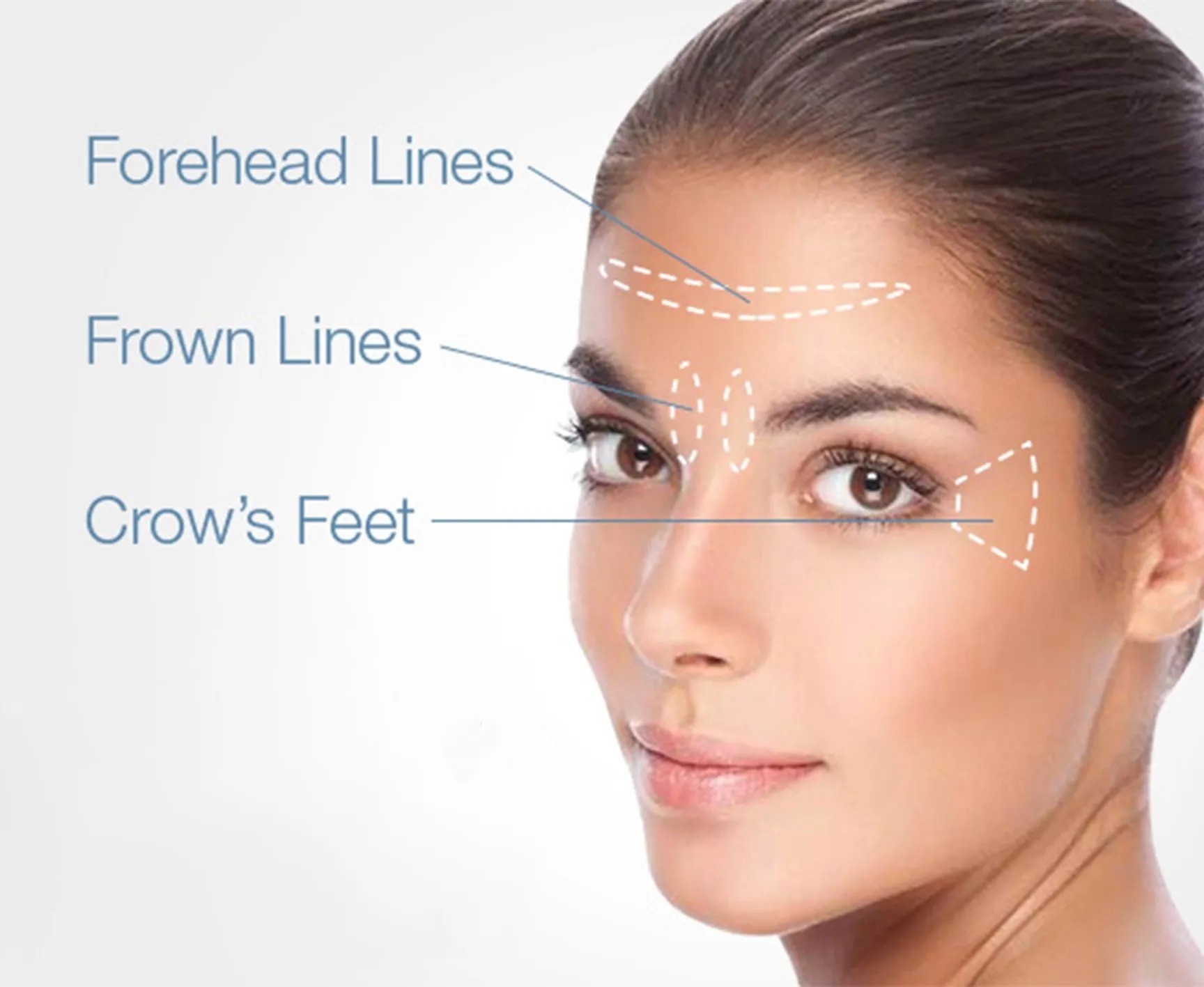 Anti Wrinkle Injections – KT skin and Aesthetics